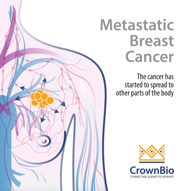 Why Pdx Are Needed For Metastatic Breast Cancer Research