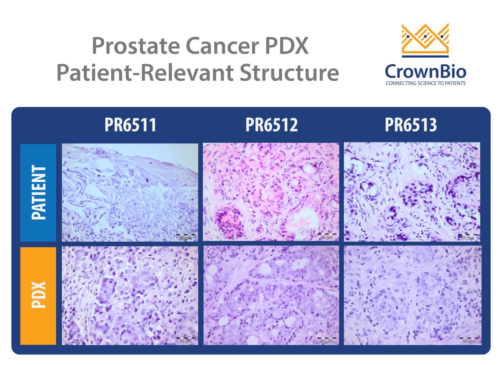 Prostate Cancer Patient-Derived Xenograft (PDX) Models Prostate Cancer Patient-Derived Xenograft (PDX) Models